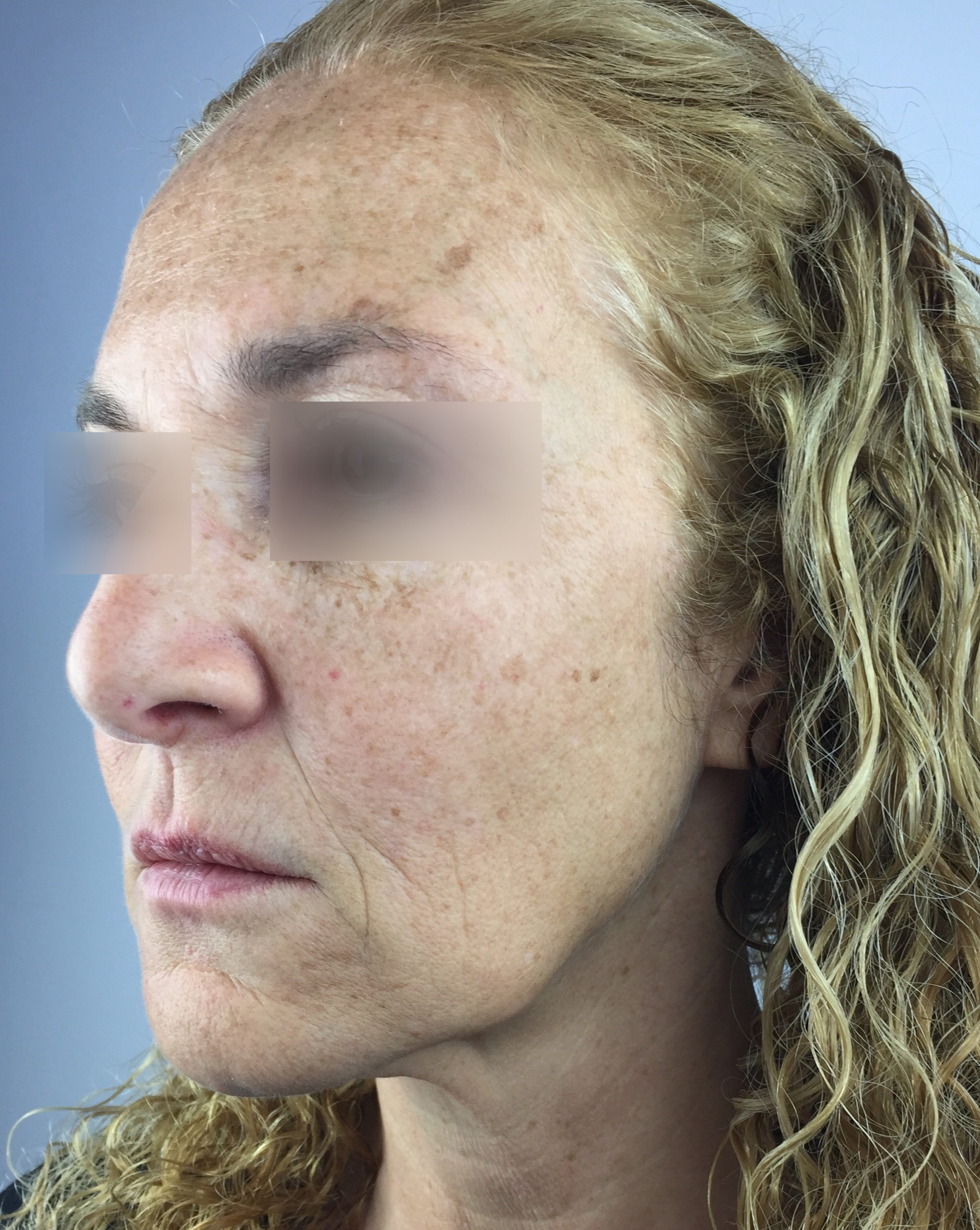 fils-tenseurs-centre-laser-medecine-esthetique-marseille-3 - Logiderm