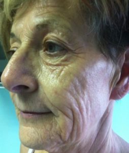 Peeling phénol - Logiderm